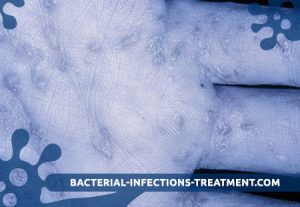 Scabies – Healthcare and Infections Treatment Blog